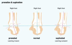 Taking a Step Inward: A ComprehensiveGuide to Excessive Pronation ...