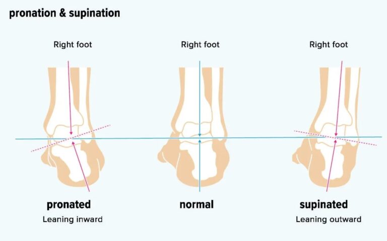 Taking a Step Inward: A ComprehensiveGuide to Excessive Pronation ...